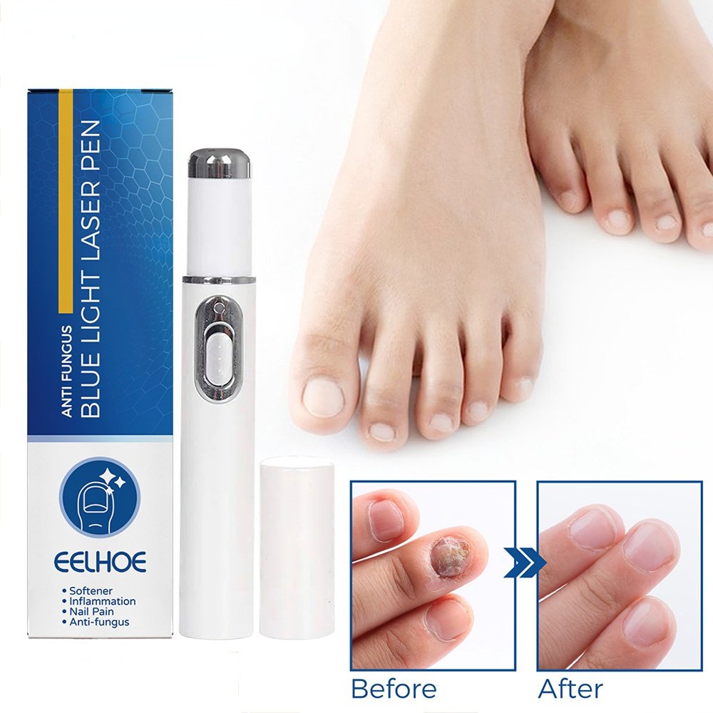 Hot Nail Fungal Pen Anti Fungus Blue Light Laser Pen Onychomycosis ...